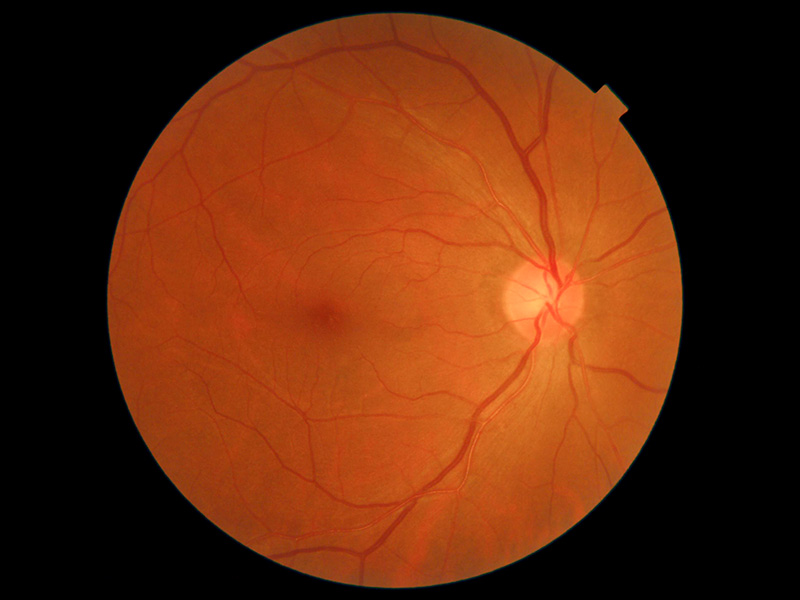 Retinografia – Clínica de Olhos Dr. Levi Madeira